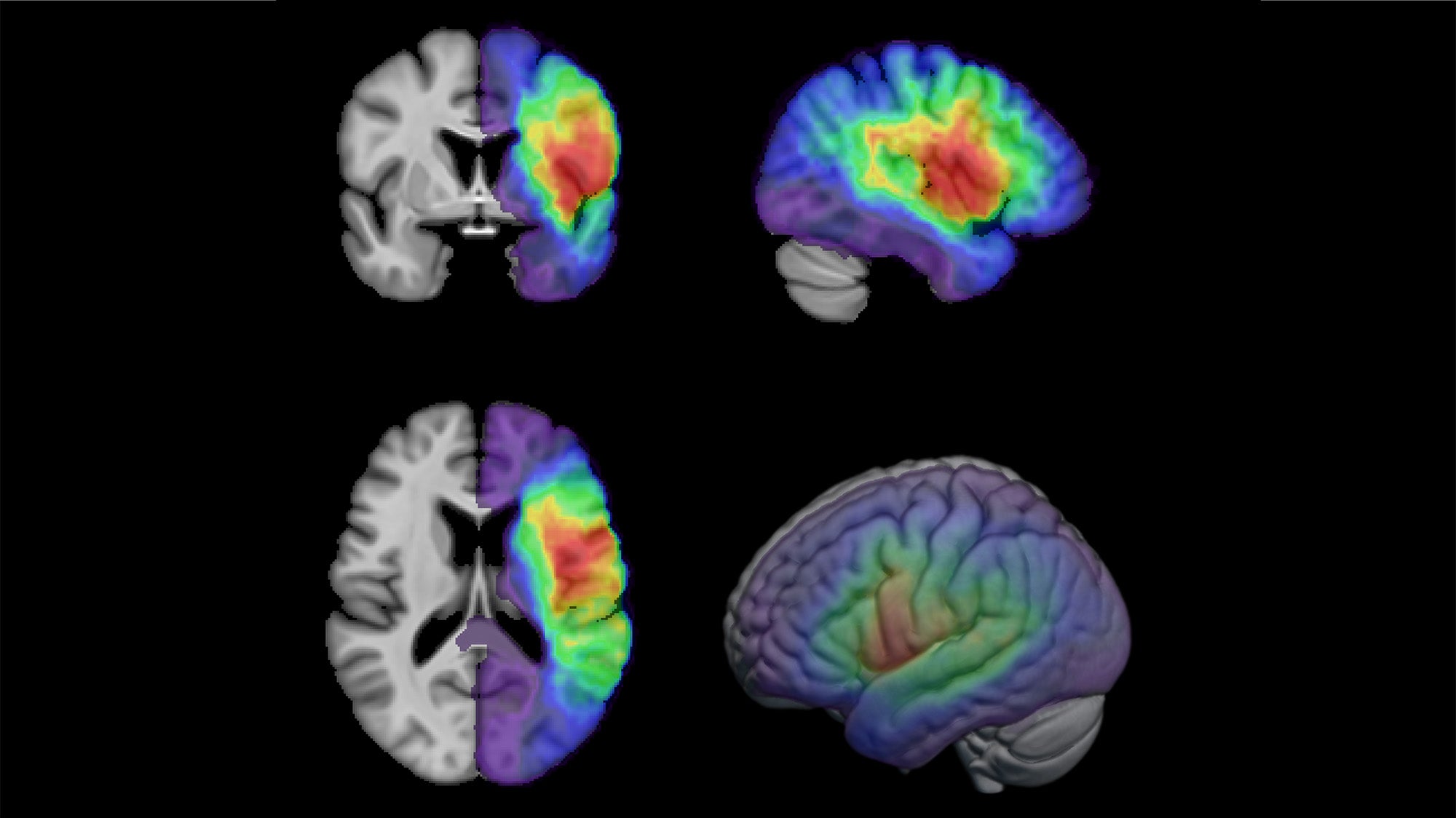 Artificial Intelligence-Driven Imaging Tool for Assessing Strokes Is ...